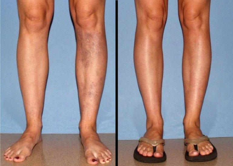 Vein Treatment Services Madison & Jackson MS | Vascular Surgeon | Vein ...